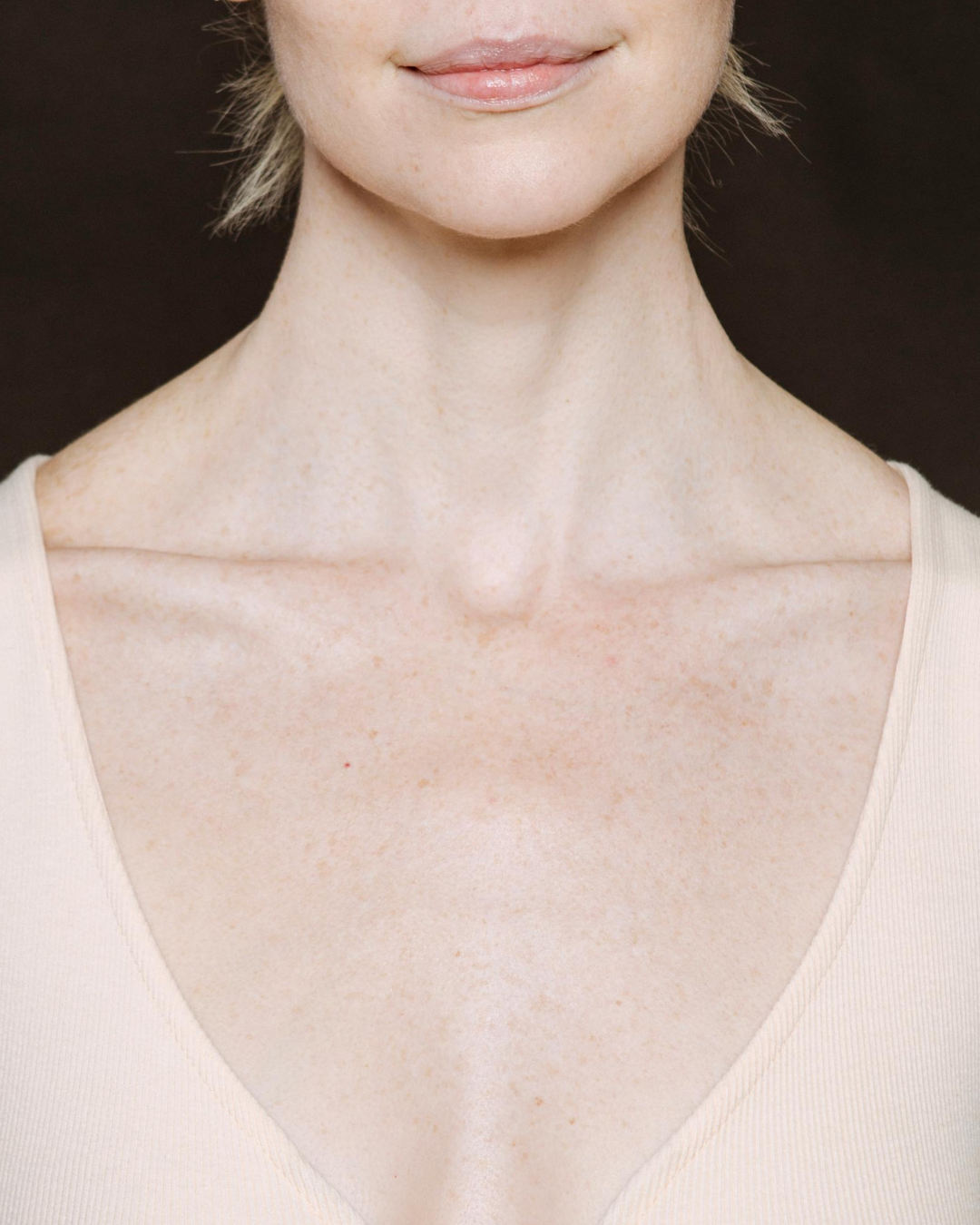 Neck & Décolletage- Smooth & Lift | Kleydman Dermatology